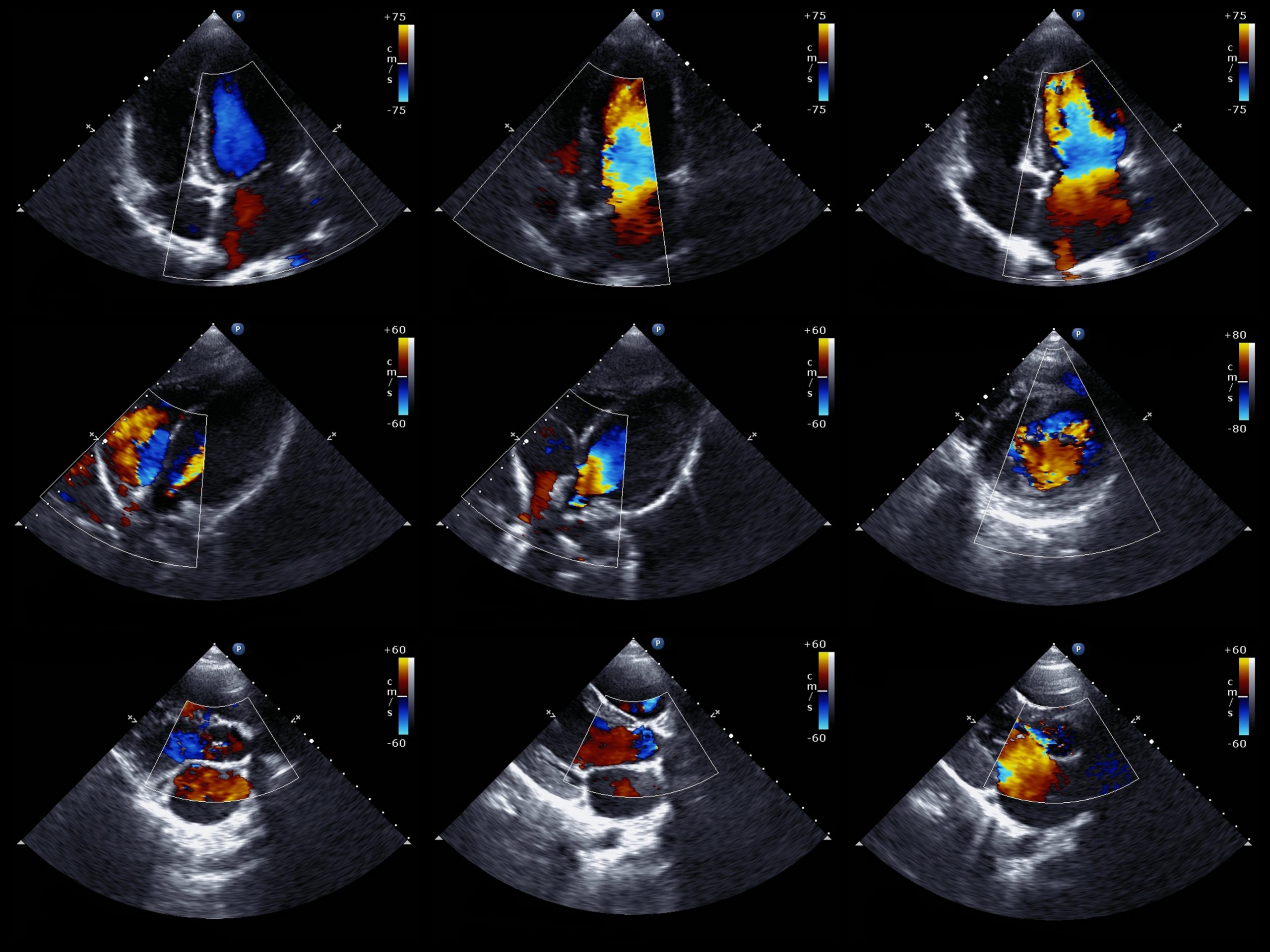 Intermediate Echo Course | Advance Your PoCUS Echo Skills